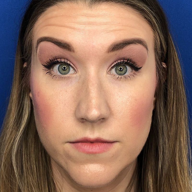 Gallery - MGMD Aesthetics