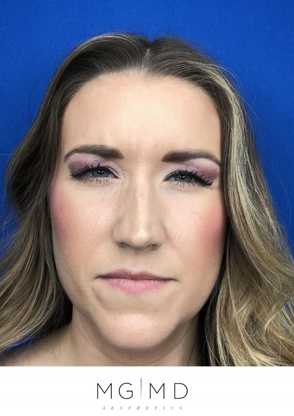 Before and After Botox Brow Furrow (11's) - MGMD Aesthetics