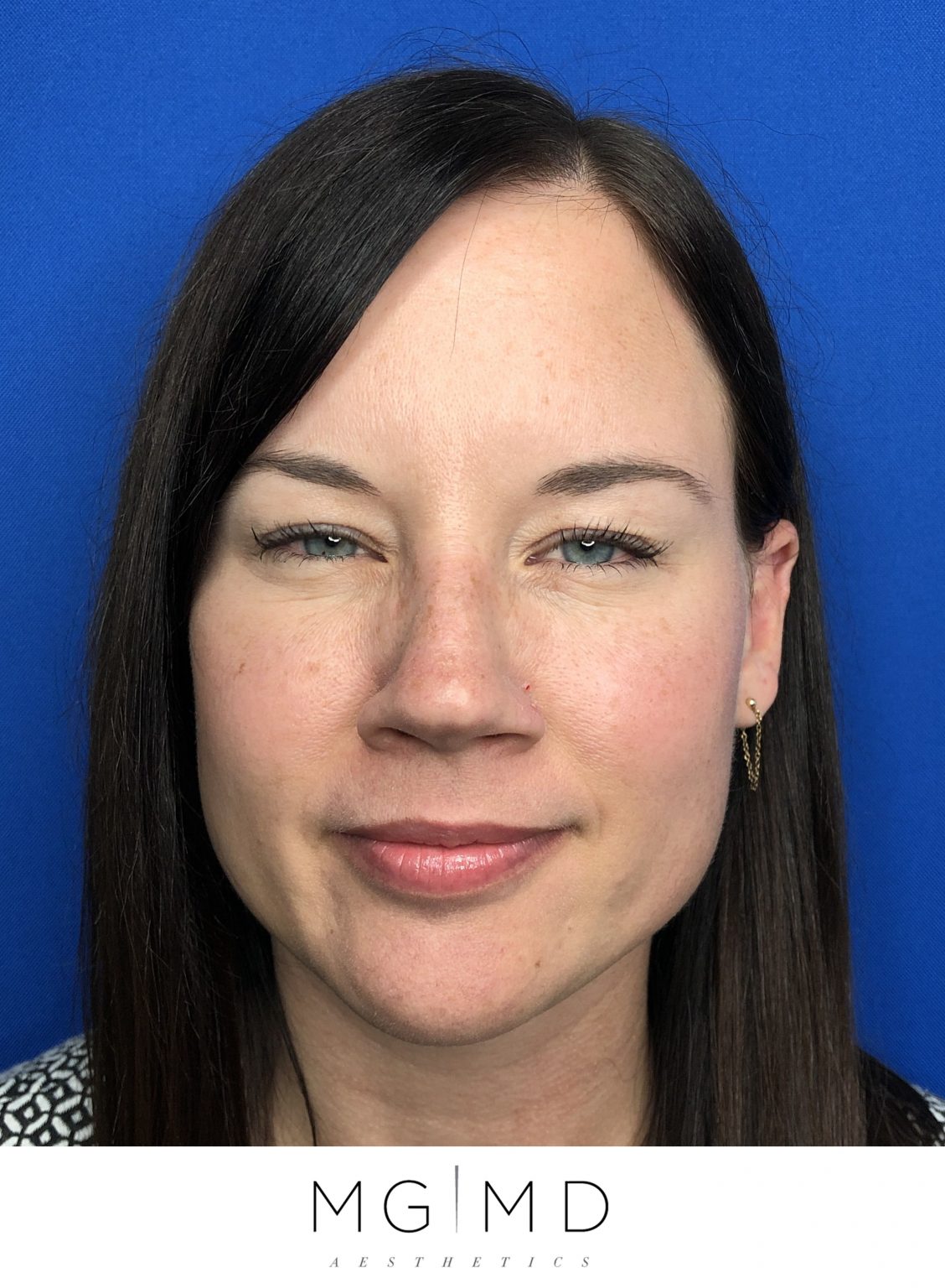 Before and After Botox Brow Furrow (11's) - MGMD Aesthetics