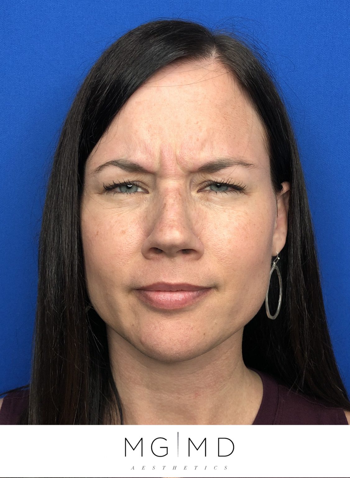 Before and After Botox Brow Furrow (11's) - MGMD Aesthetics