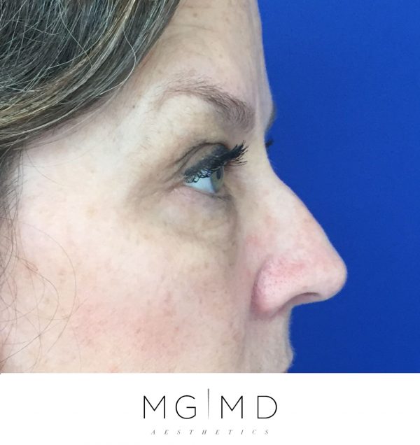 Before and After Tear Trough (under eye) Filler - MGMD Aesthetics